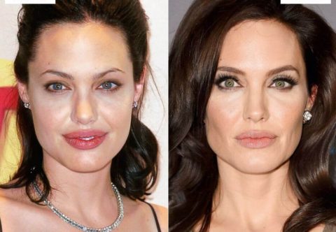 Todo lo que debes saber sobre la bichectomía - Malilla Dental